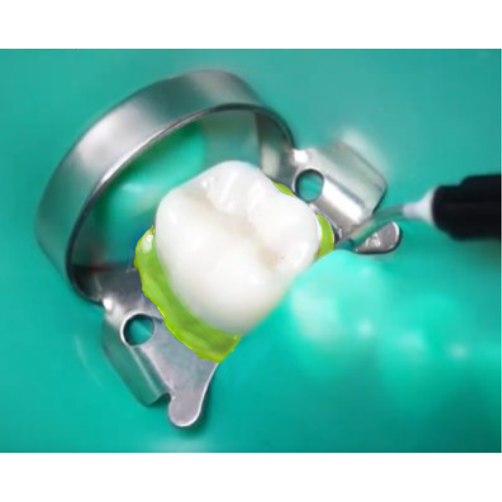 M1040 Flowdam™ Flowable Dental Dam Kit, 4 Syringe + 25 ...